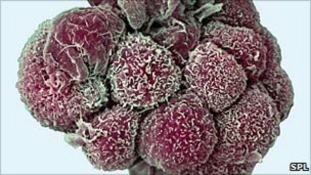 Cancer 'is nation's biggest fear' - BBC News