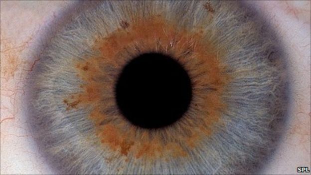 Age related macular degeneration clue discovered - BBC News