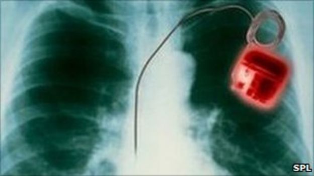 Charity funding secured for new pacemaker service. - BBC News