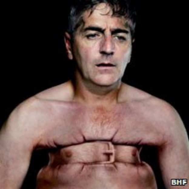 Heart medicine advances help patients enjoy active life - BBC News