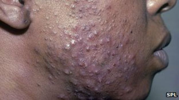 Why spotting the best acne treatment is a pain - BBC News