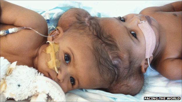 Separating conjoined twins Rital and Ritag: the journey - BBC News