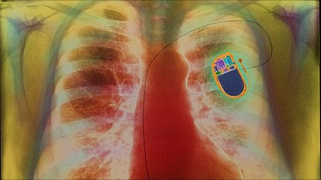 Sweat-powered battery could charge your phone - BBC News