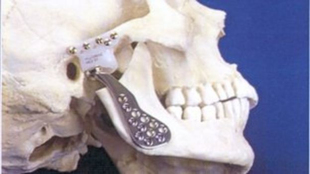 'Jaw replacement surgery ended my unbearable pain' - BBC News