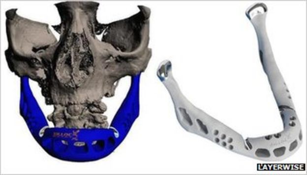 Transplant jaw made by 3D printer claimed as first - BBC News
