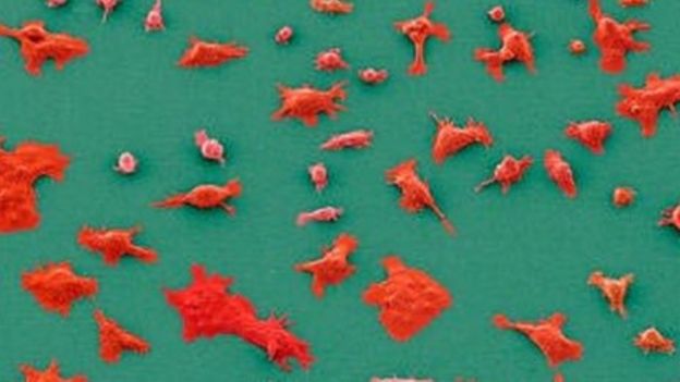 Pancreatic cancer 'missed 19 times by NHS' - BBC News