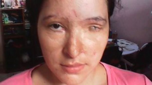 Colombia acid victims seek justice as attacks spread - BBC News