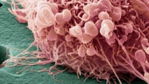 Breast cancer: Leeds study highlights need to focus on recurrence - BBC ...