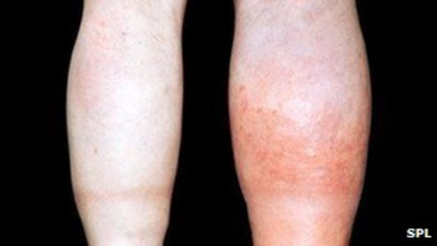 Blood clot care risking lives, NICE says - BBC News