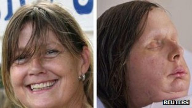 US chimp-attack victim says state failed to heed warning - BBC News