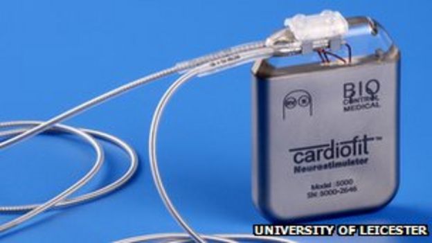 Heart failure implant operation trialled in UK - BBC News
