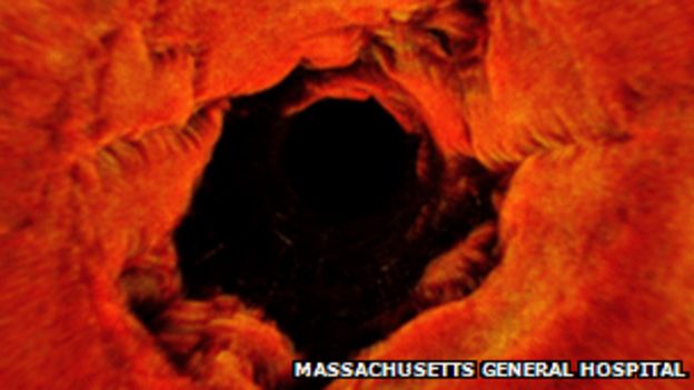 Pill-sized scanner images gullet - BBC News