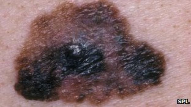 Skin cancer 'able to fight off body's immune system' - BBC News