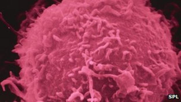 University of Dundee uncovers new way to treat leukaemia - BBC News