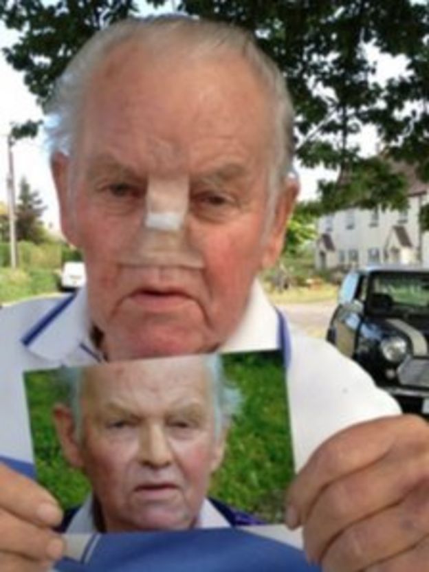 Plea for return of man's lost artificial nose - BBC News