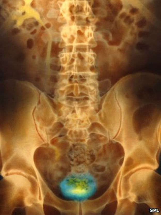 Spinal cord injury: Prosthetic bladder 'controls urine' - BBC News