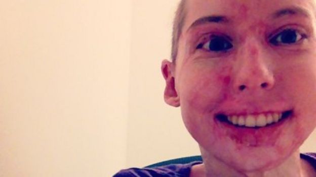 Burns survivor Catrin Pugh is face of Avon beauty campaign - BBC News