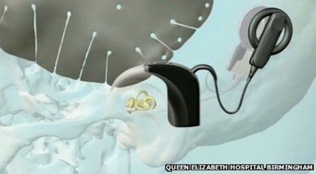 What are cochlear implants and how do they work? - BBC Newsround
