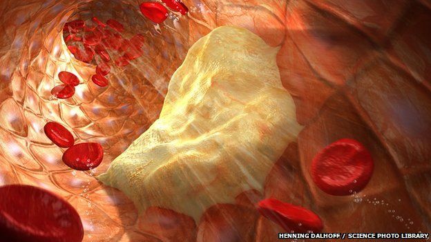 Genetic test for heart disease risk rolled out in UK - BBC News