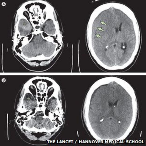 Headbanging can cause brain injury, say German doctors - BBC News