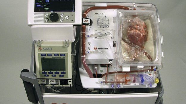 Europe's first non-beating heart transplant - BBC News