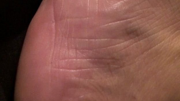 Six-fold rise in bed sore patients at South Warwickshire NHS Foundation ...