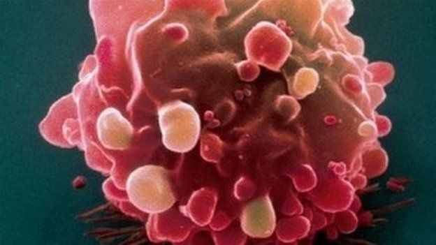 Skin cancer cases in Scotland rise by almost a third - BBC News