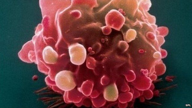 Scottish cancer cases reach 'record high' - BBC News