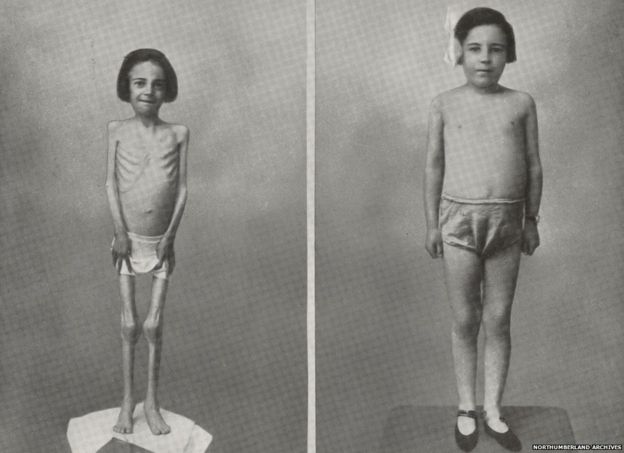 Stannington Sanatorium photos shine light on TB before antibiotics - BBC News