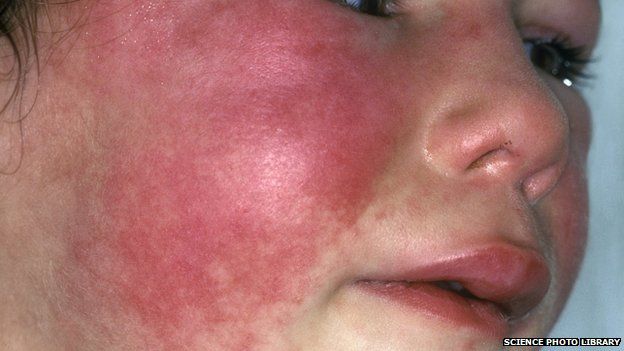 Scarlet fever cases soar in England - BBC News
