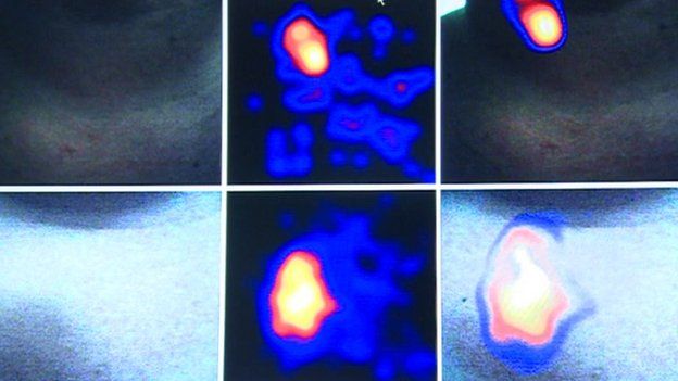 Gamma ray cancer scanners to be trialled in East Midlands - BBC News