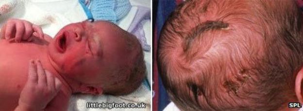 Odon childbirth device: Car mechanic uncorks a revolution - BBC News