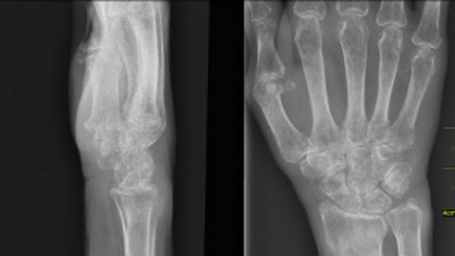 Osteoporoz teşhisinde 'yeni bir yöntem' - BBC News Türkçe