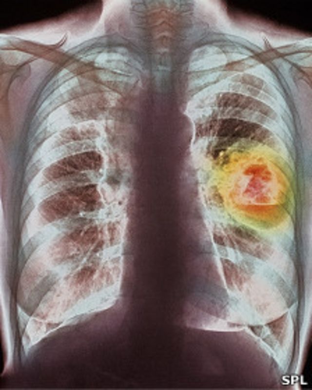 El cáncer de pulmón supera al cáncer de mama en Europa - BBC News Mundo