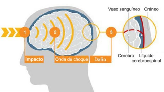 La epidemia invisible de la conmoción cerebral - BBC News Mundo