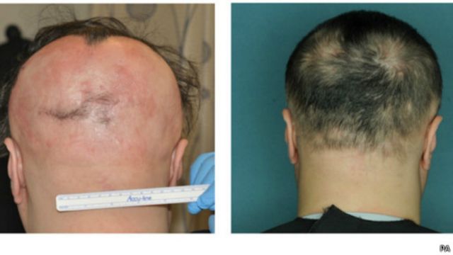 Harapan baru bagi penderita kebotakan - BBC News Indonesia