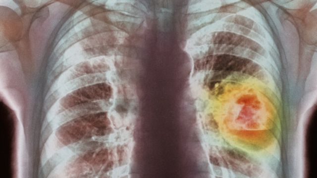 Kinga ya mwili kutibu saratani? - BBC News Swahili