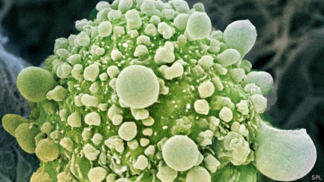 Cancer du pancréas : découverte inédite - BBC News Afrique