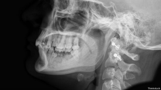 ¿Por qué solo los humanos tenemos barbilla? - BBC News Mundo