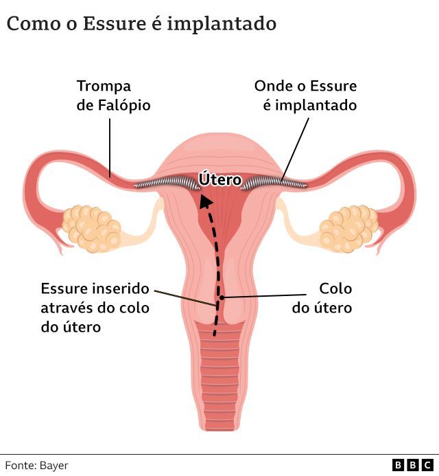 'Nos venderam uma falsa ilusão': o sofrimento de mulheres com o método contraceptivo Essure anos ...