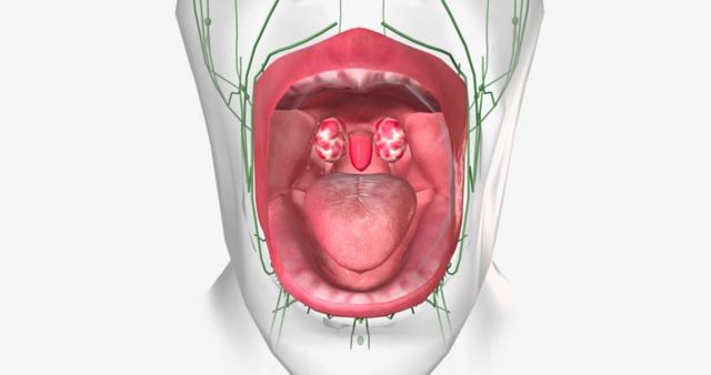 Kwa nini watoto mara nyingi wanakabiliwa na mafindofindo ‘tonsillitis ...