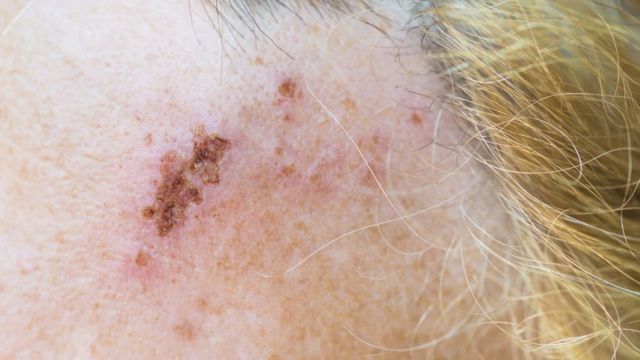 Herpes Zóster A Doença Causada Pelo Vírus Da Catapora Que Pode Ser
