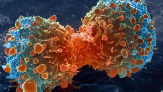 புற்றுநோய்: எதனால் உண்டாகிறது? எவ்வாறு தவிர்ப்பது? - BBC News தமிழ்