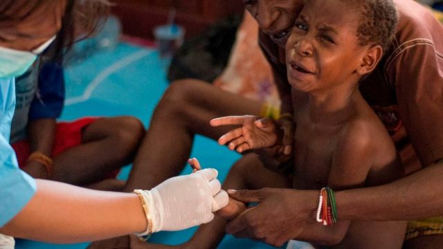 Lima hal yang perlu Anda ketahui tentang wabah campak dan gizi buruk di Asmat - BBC News Indonesia