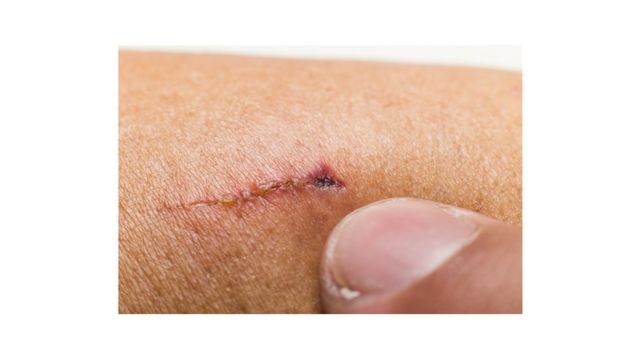 Ferimentos diurnos cicatrizam mais rápido que os noturnos, mostra ...