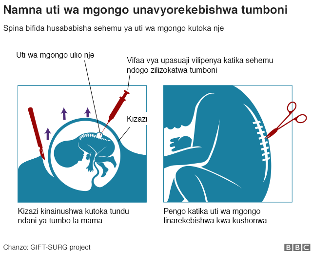 Watoto wafanyiwa upasuaji wa uti wa mgongo wakiwa tumboni mwa mama zao ...