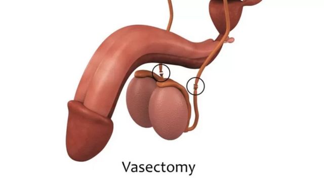 Vasectomy: You go fit stop di flow of your sperm as you no want more pikin? - BBC News Pidgin