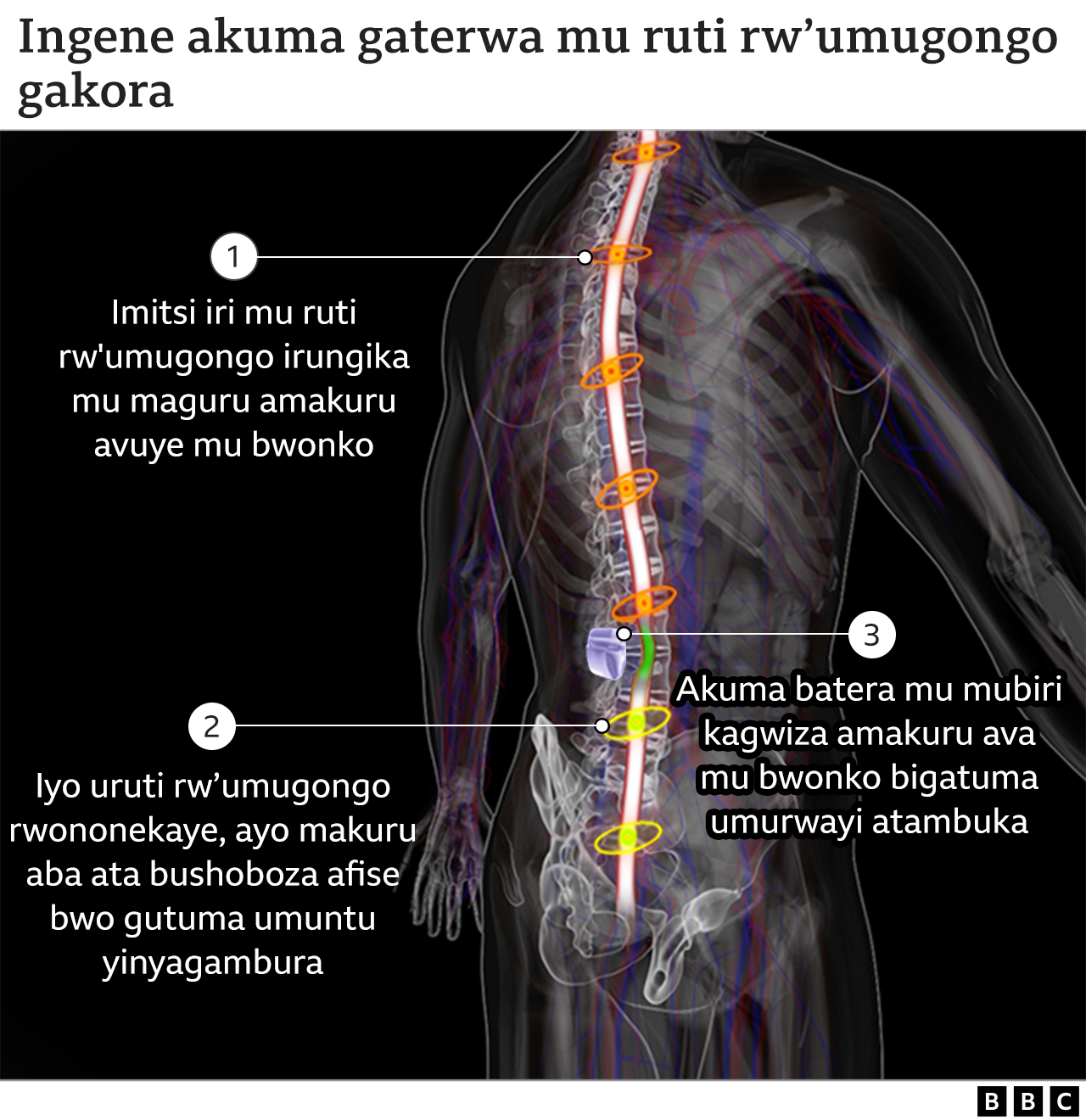 Umugabo yamugaye inyuma yo gucika uruti rw'umugongo yasubiye gutambuka ...