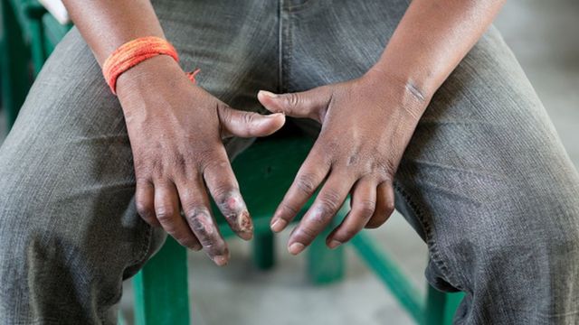 සමේ ලප ගැන දෙවරක් සිතන්න: ශ්‍රී ලංකාවේ ලාදුරු රෝගීන්ගෙන් 10%ක් ළමුන් ...