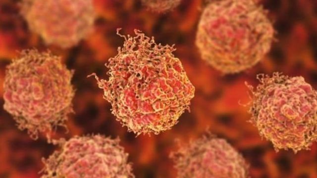 Saratani ya Matiti: Utafiti umebaini wanawake walio katika hatari ya ...